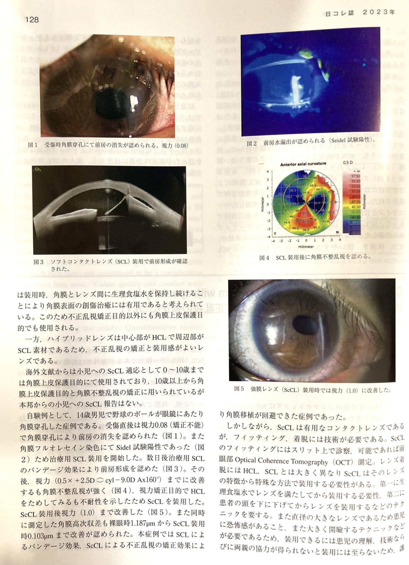 『Correction of irregular astigmatism with specialty lens 特殊コンタクトレンズを使用し ...